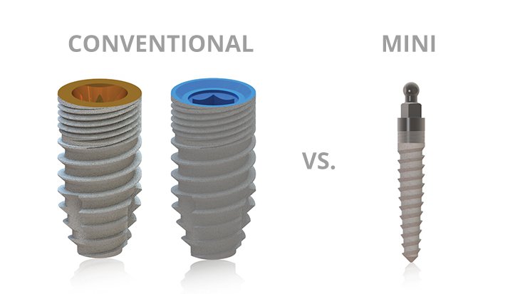 Mini Implants Vs. Regular Implants - Sterngold
